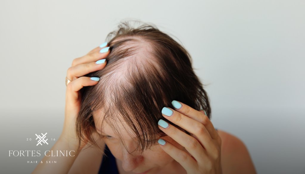 Understanding Alopecia Symptoms | Fortes Clinic